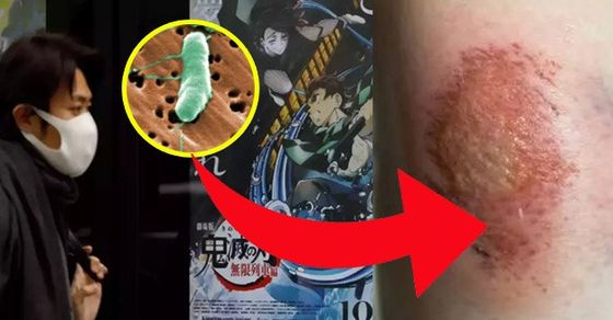 Flesh Eating Bacteria Japan Outbreak: Losing Life In 48 Hours, Symptoms ...