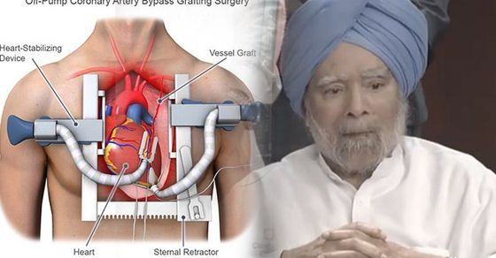 Former PM Dr. Manmohan Singh Underwent 5 Bypass Surgery क्या है ...