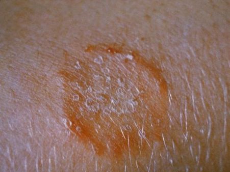 Peeling Skin: Causes, Symptoms, Diagnosis And Treatment - Boldsky.com