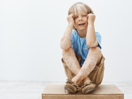 What Is Vitiligo? Causes, Types, Symptoms, Complications And Treatment ...