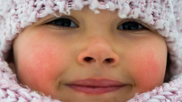 Winter Rosacea: ठंड लगने पर क्यों गुलाबी और लाल हो जाते हैं गाल? जानिए ...