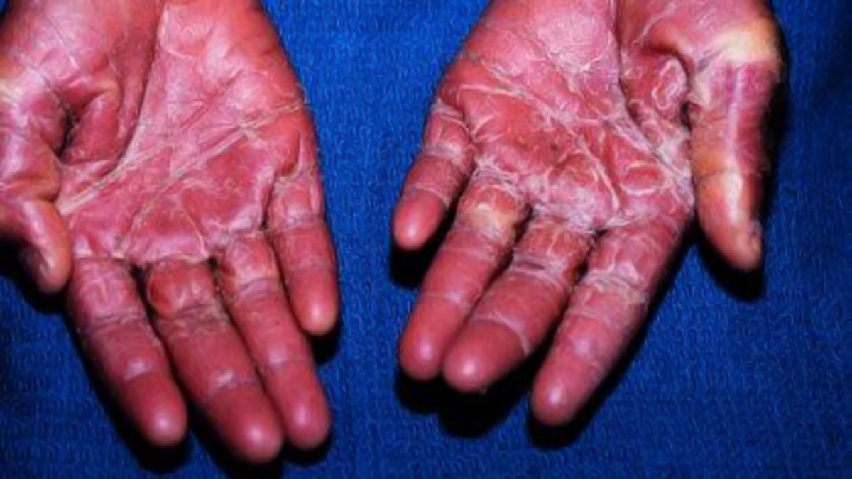 STSS बैक्‍टीरिया क्‍या है, जिससे 48 घंटों में हो जाती है मौत, जापान में ...