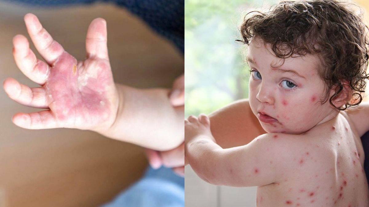 Slapped Cheek Virus क्या है? जिसमें गाल हो जाते हैं टमाटर जैसे लाल, इस ...
