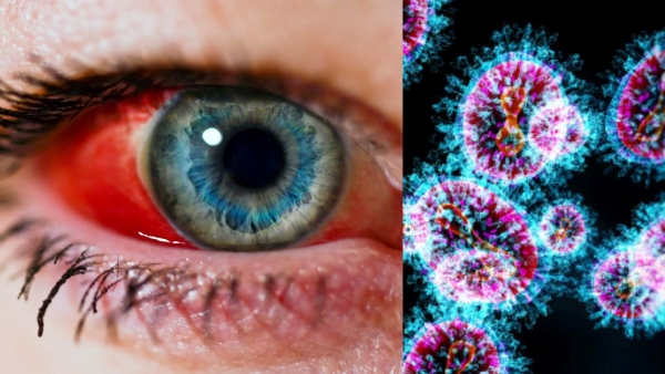 Bleeding Eye Virus से अब तक 15 की मौत, अफ्रीका जाने वाले सावधान रहें, WHO ने किया अलर्ट | What ...