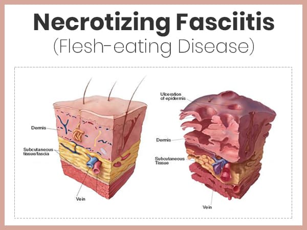 Necrotizing Fasciitis: Causes, Symptoms, Diagnosis, Treatment, And Prevention - Boldsky.com