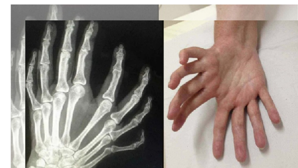 What Is Mirror Hand Syndrome? Diagnosis, Treatment, And Awareness ...