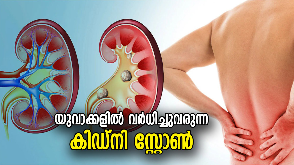 യുവാക്കളില് വര്ധിച്ചുവരുന്ന കിഡ്നി സ്റ്റോണ് കാരണങ്ങള് അറിഞ്ഞ്
