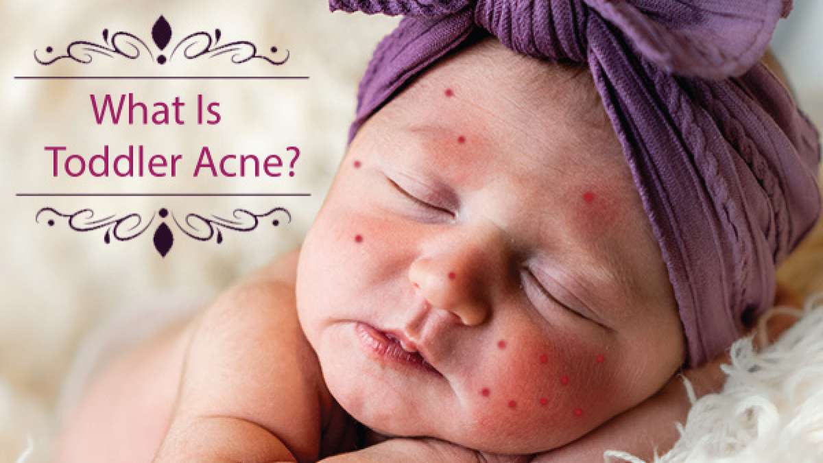 Toddlers Acne: చిన్నారుల్లో మొటిమలా? ఎందుకు వస్తాయంటే.. | Do children ...
