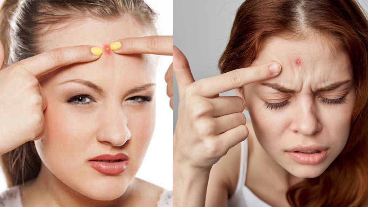 Pimples on Forehead: నుదిటిపై తరచుగా మొటిమలు వస్తున్నాయా? శరీరంలోని ఆ ...